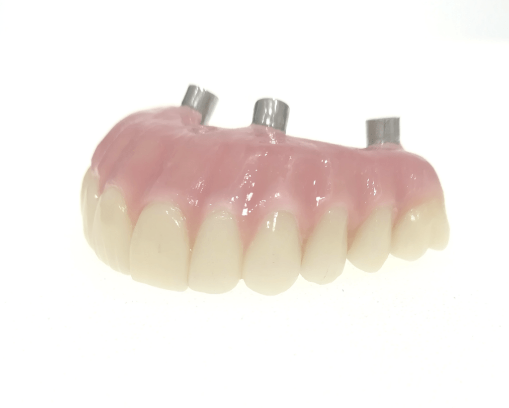 Prótesis Dental Fija | Avilés Digital Dental Clinic